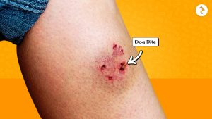 Dog Bite Injection: Get Immediate Treatment Without Any Delay
